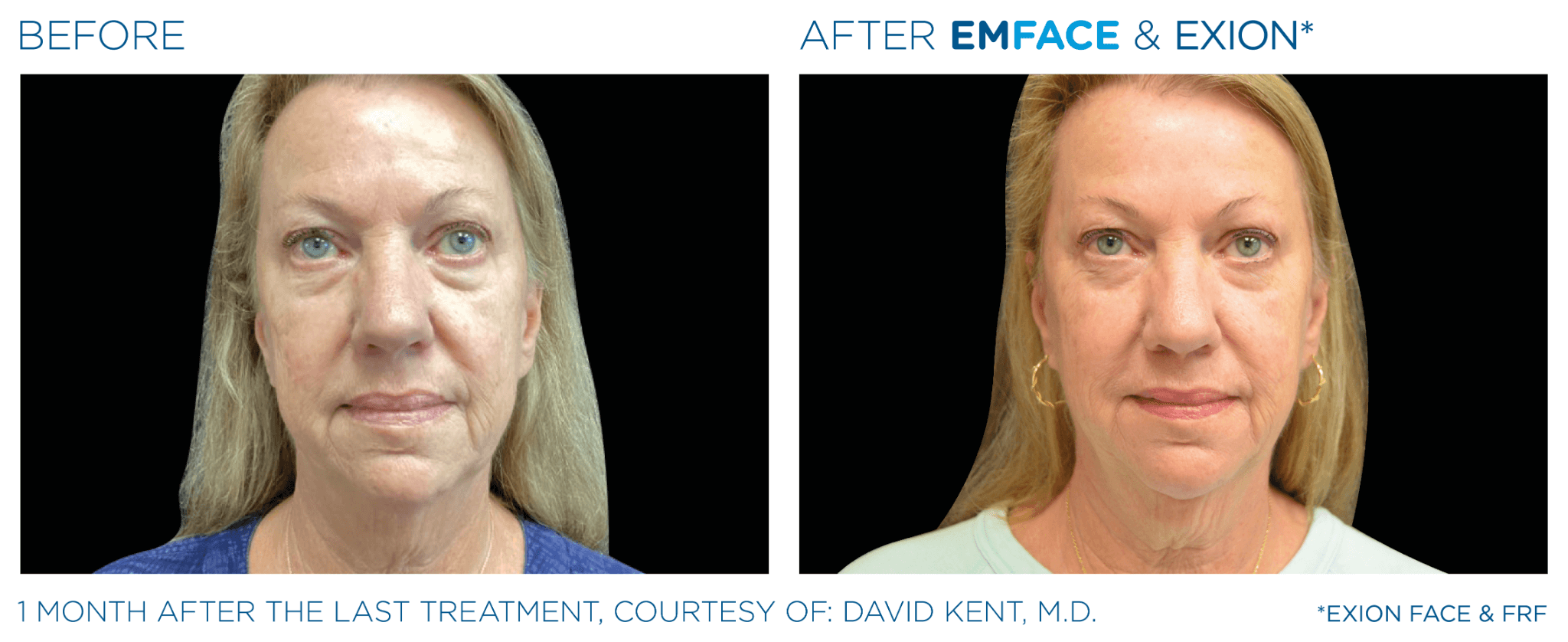 Exion Chicago - R.A.M Plastic Surgery