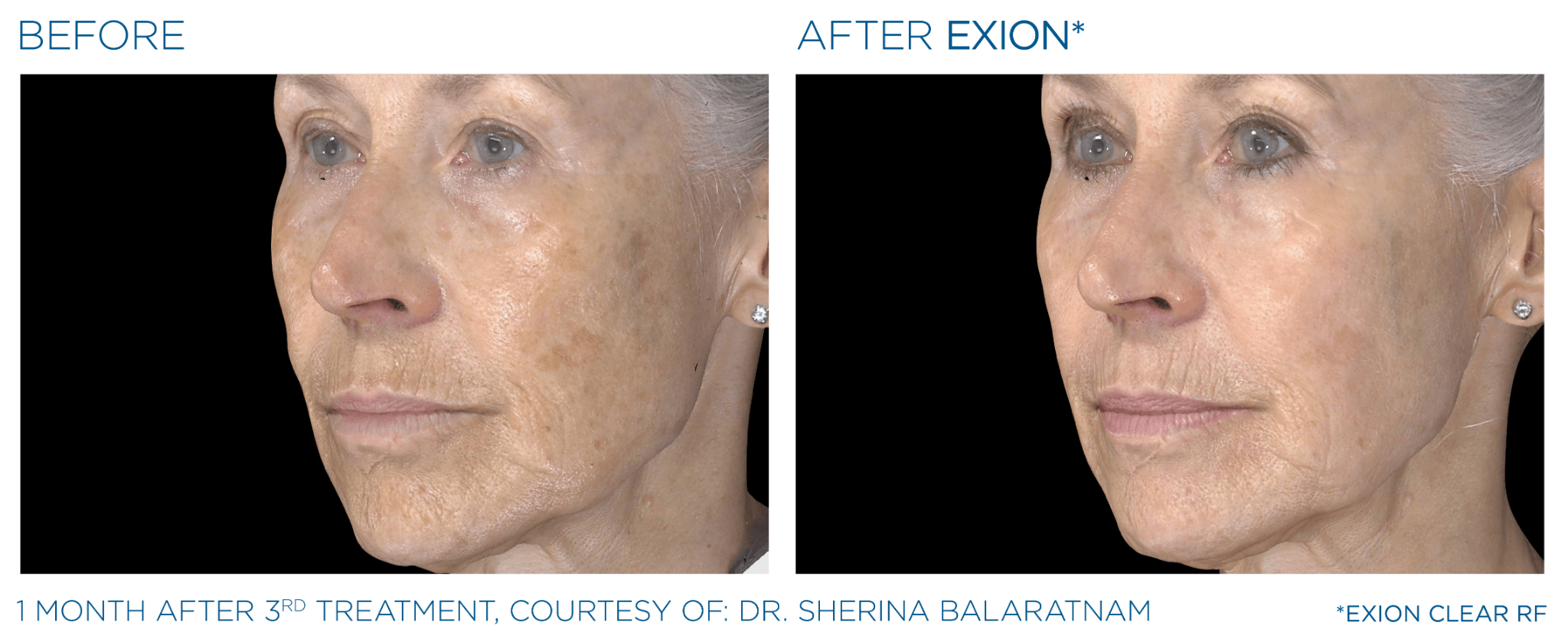 Exion Chicago - R.A.M Plastic Surgery