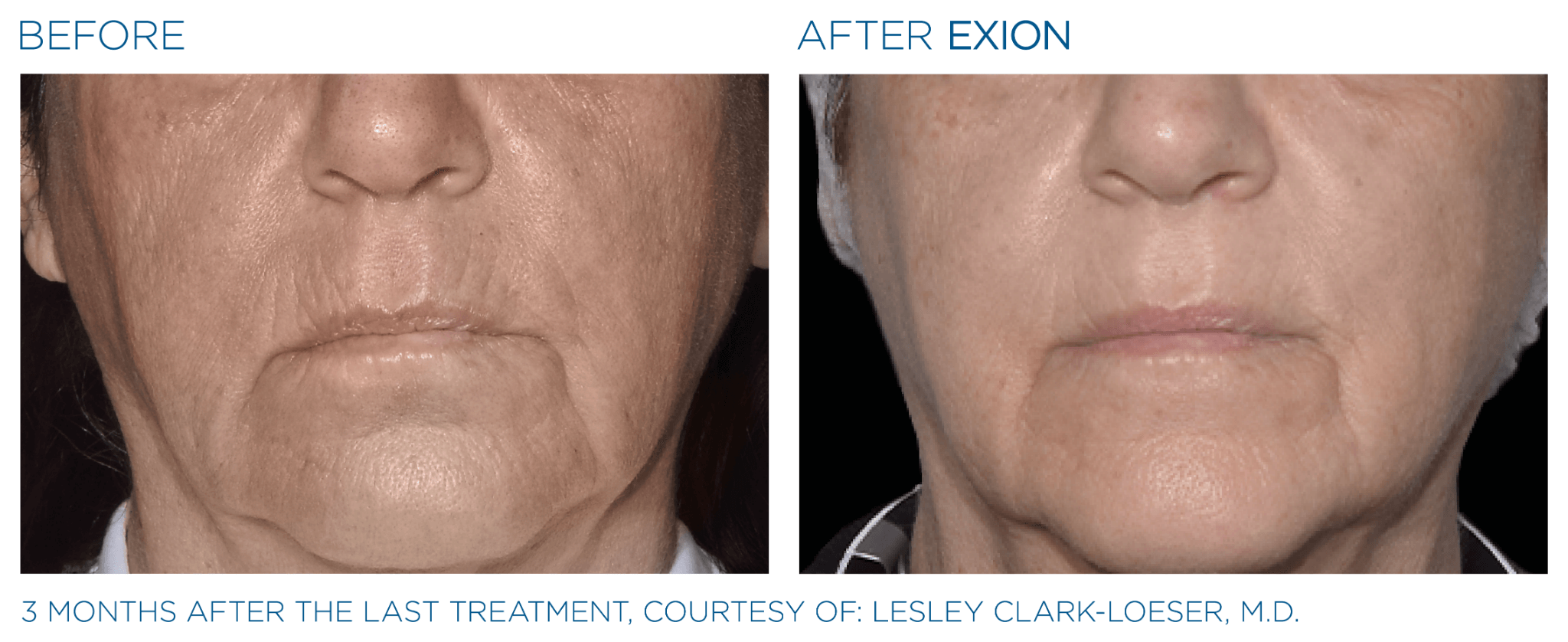 Exion Chicago - R.A.M Plastic Surgery