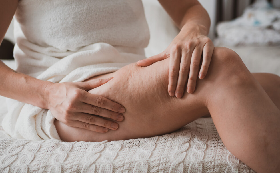 Does Liposuction Remove Cellulite ? - R.A.M Plastic Surgery